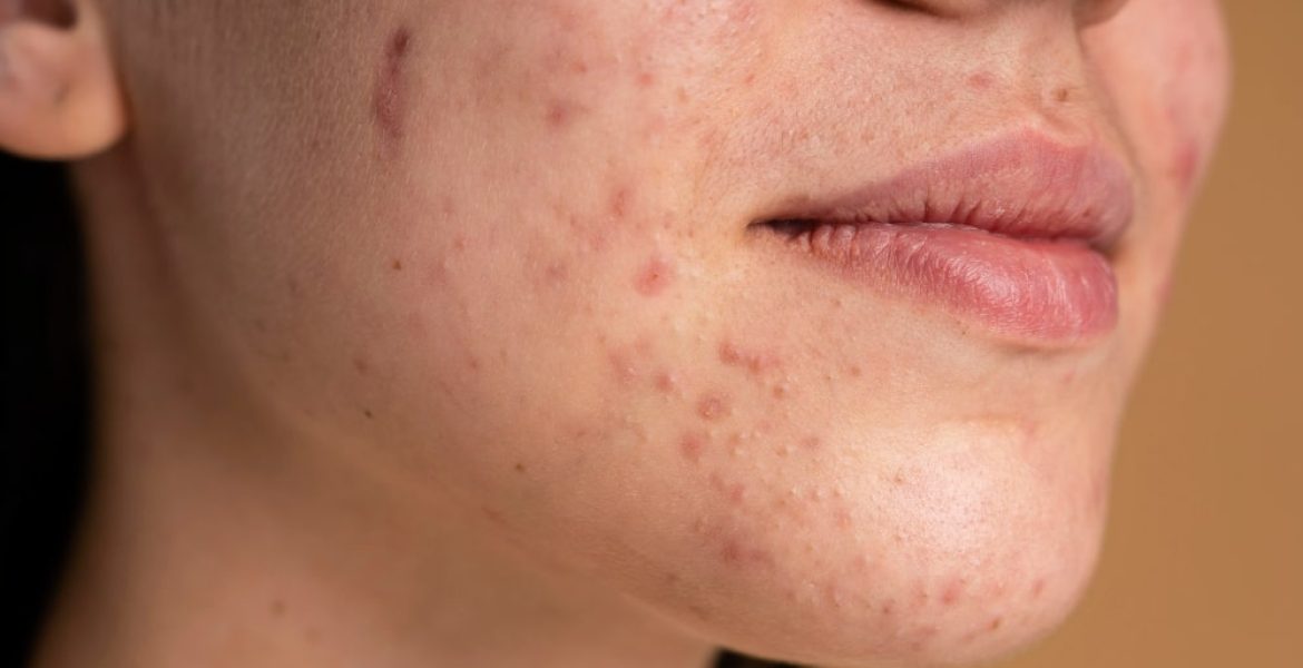 Acne / Scars – OH Clinic